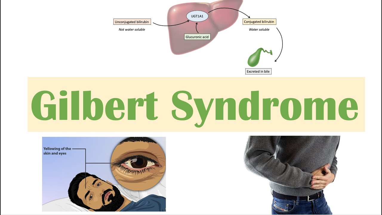 What is a liver function test for Gilbert's syndrome? - ABTC